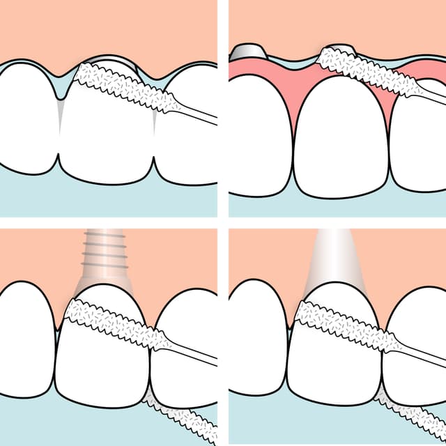 TePe® Bridge & Implant Floss